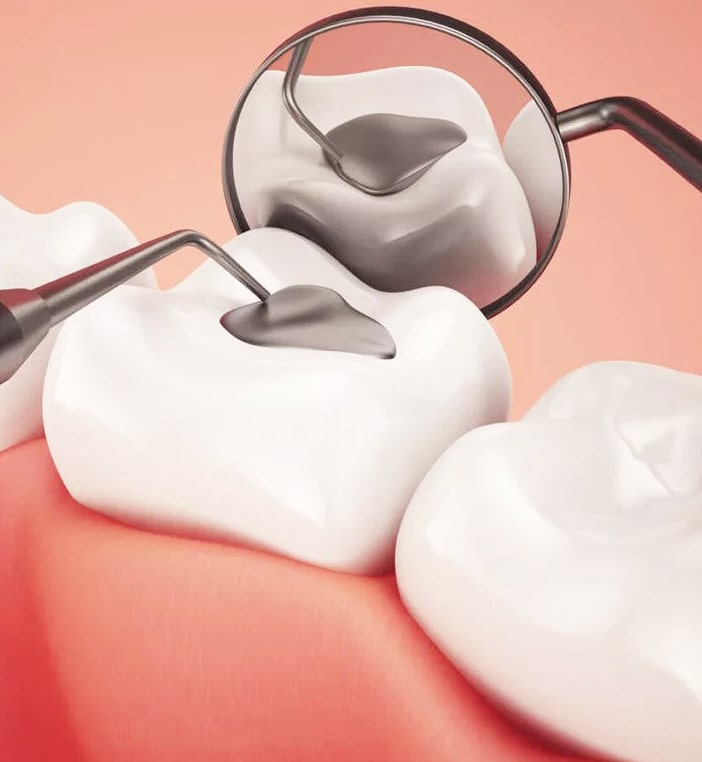 Dental Sealants in Buckeye, AZ | Market Street Dental Studio