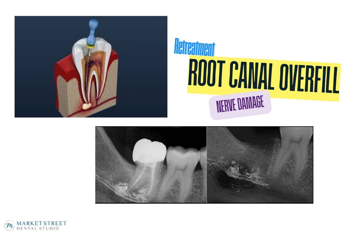 How Do I Know if I Have Nerve Damage from a Root Canal?