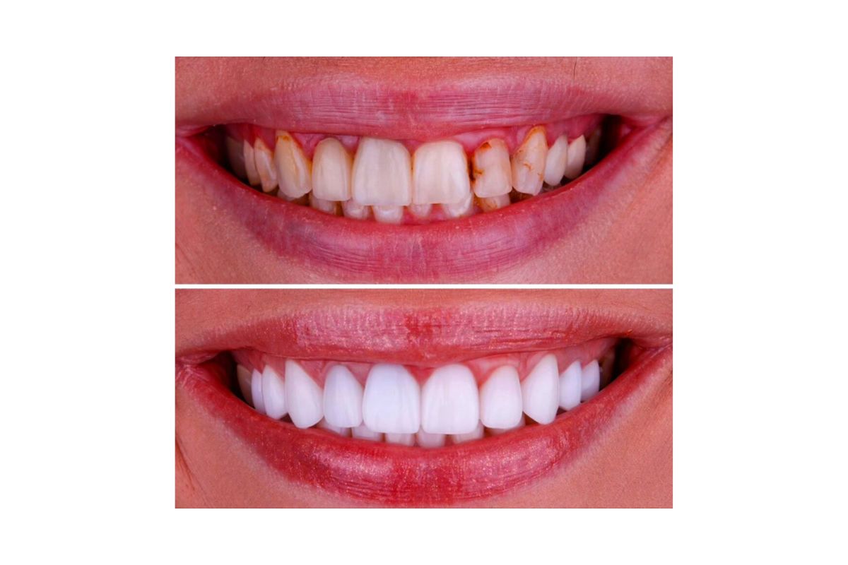Pros and Cons of Composite Bonding