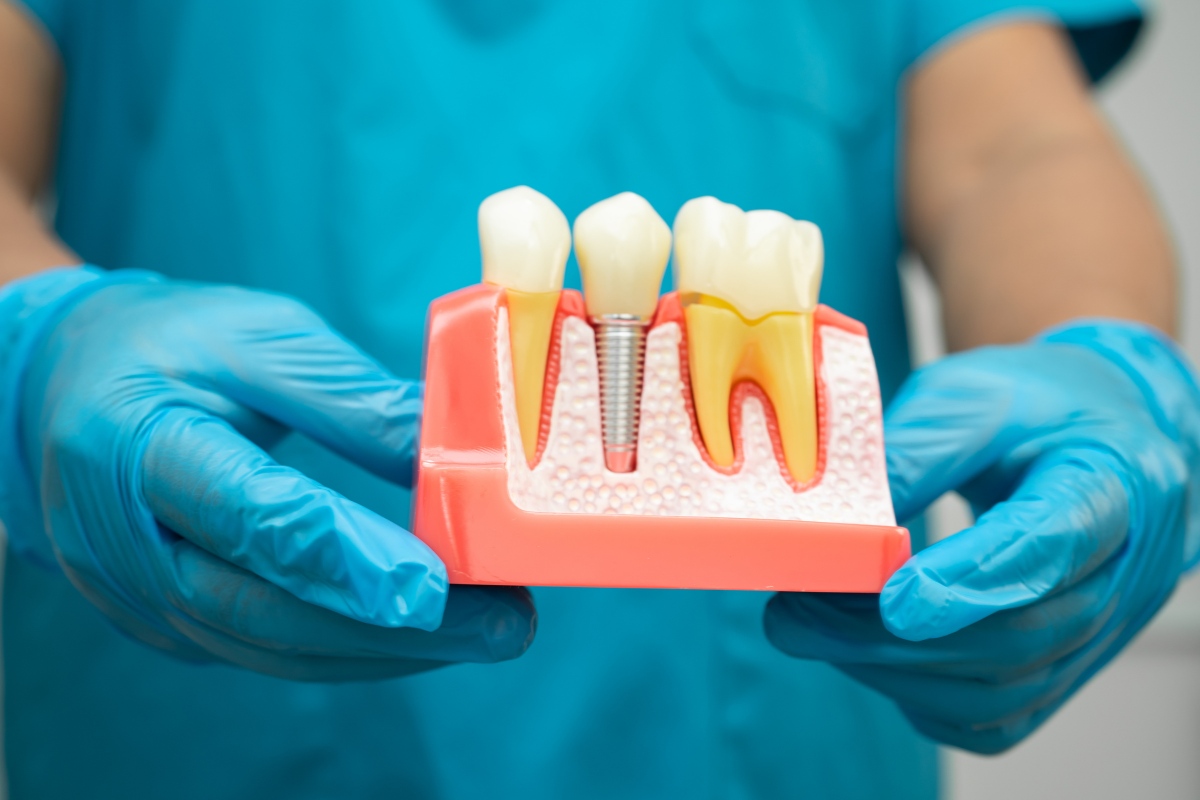 Replacing Adjacent Missing Teeth with Double Restorations